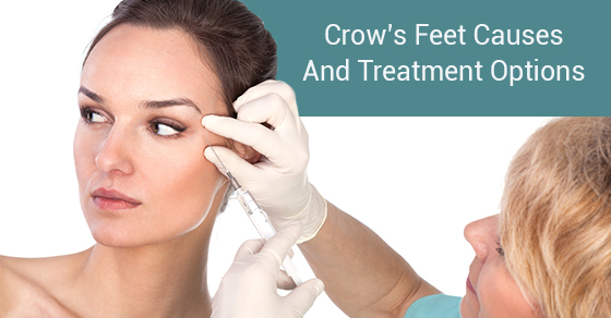 The Causes Of Crow’s Feet And Treatment Options
